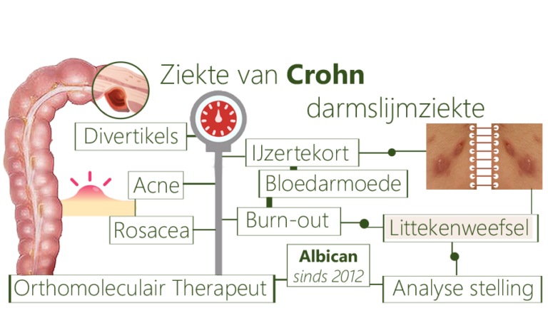 Ziekte van Crohn, darmslijmziekte door granuloomophoping
